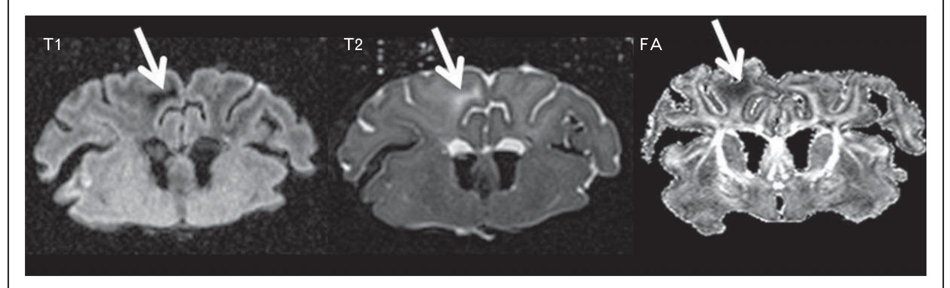 Lps-induced diffuse wm lesions: coronal t;w, t2w images, and