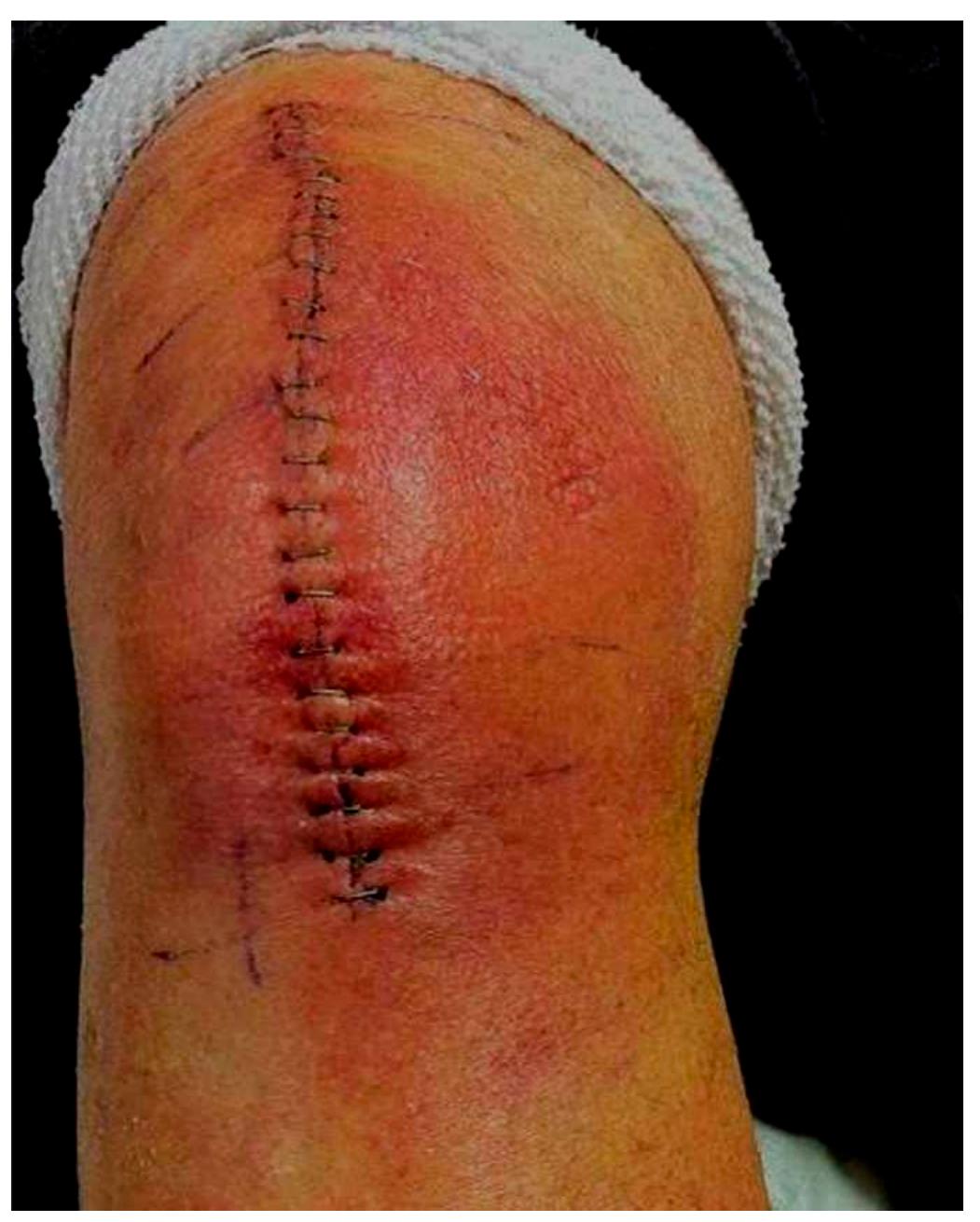 Postoperative cellulitis after total knee arthroplasty.