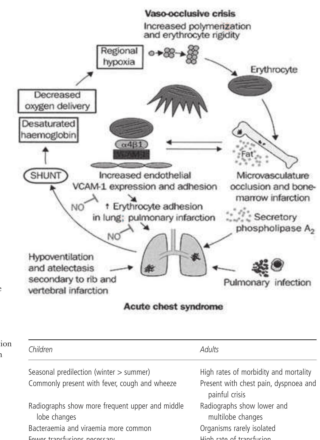 Commonly with multilobe involvement and pleural effusion.
