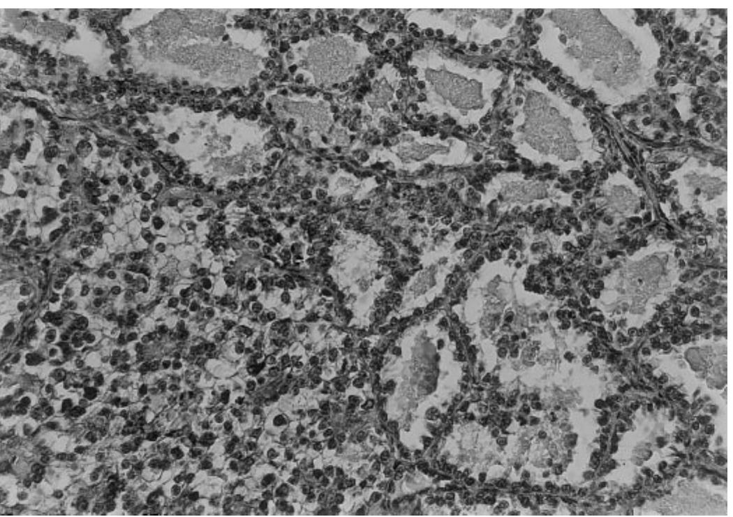 Histologic appearance of a cervical cca, tubulocystic type.