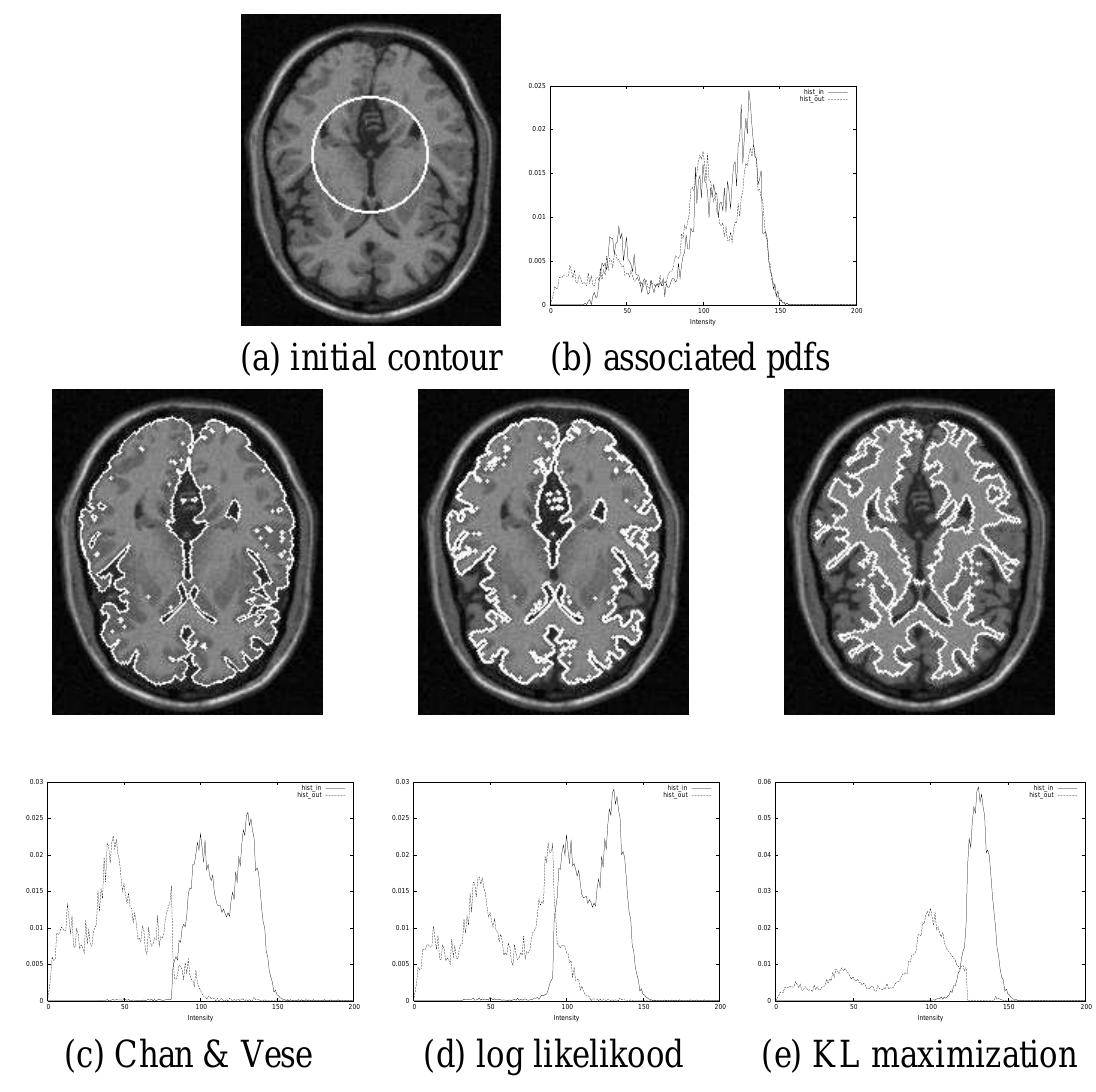 T1-weighted brain mri segmentation results (extraction of