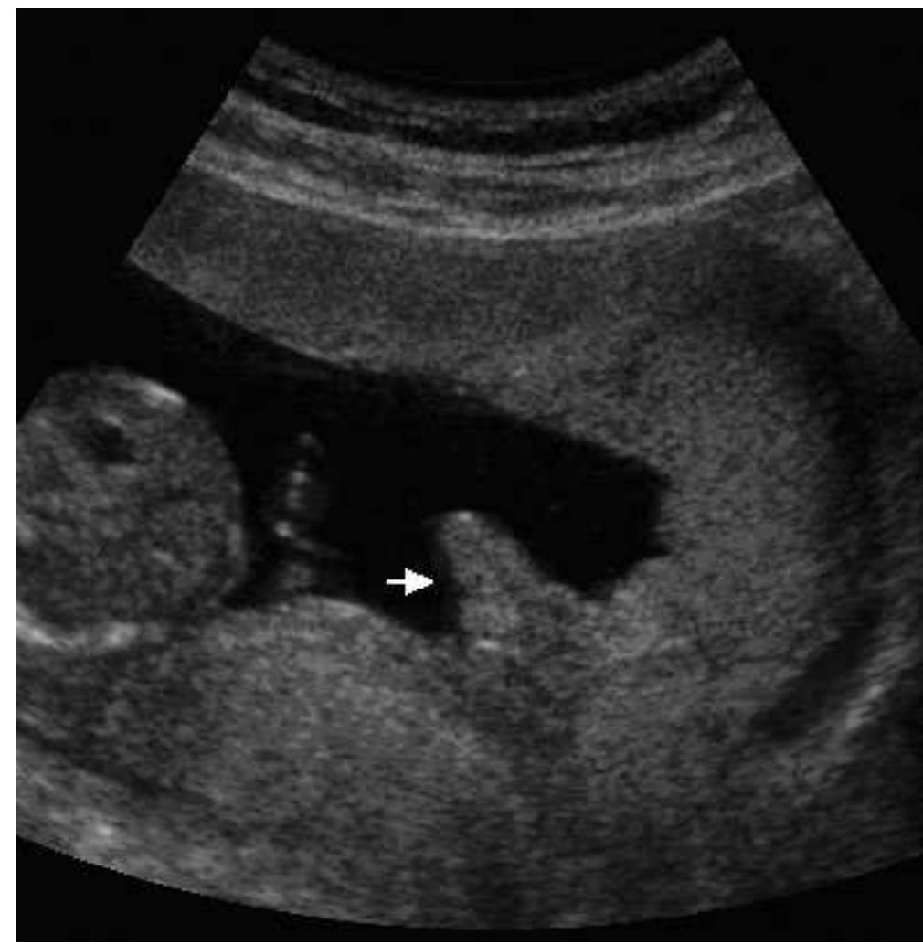 (PDF) Placental shelf - a common, typically transient and benign ...