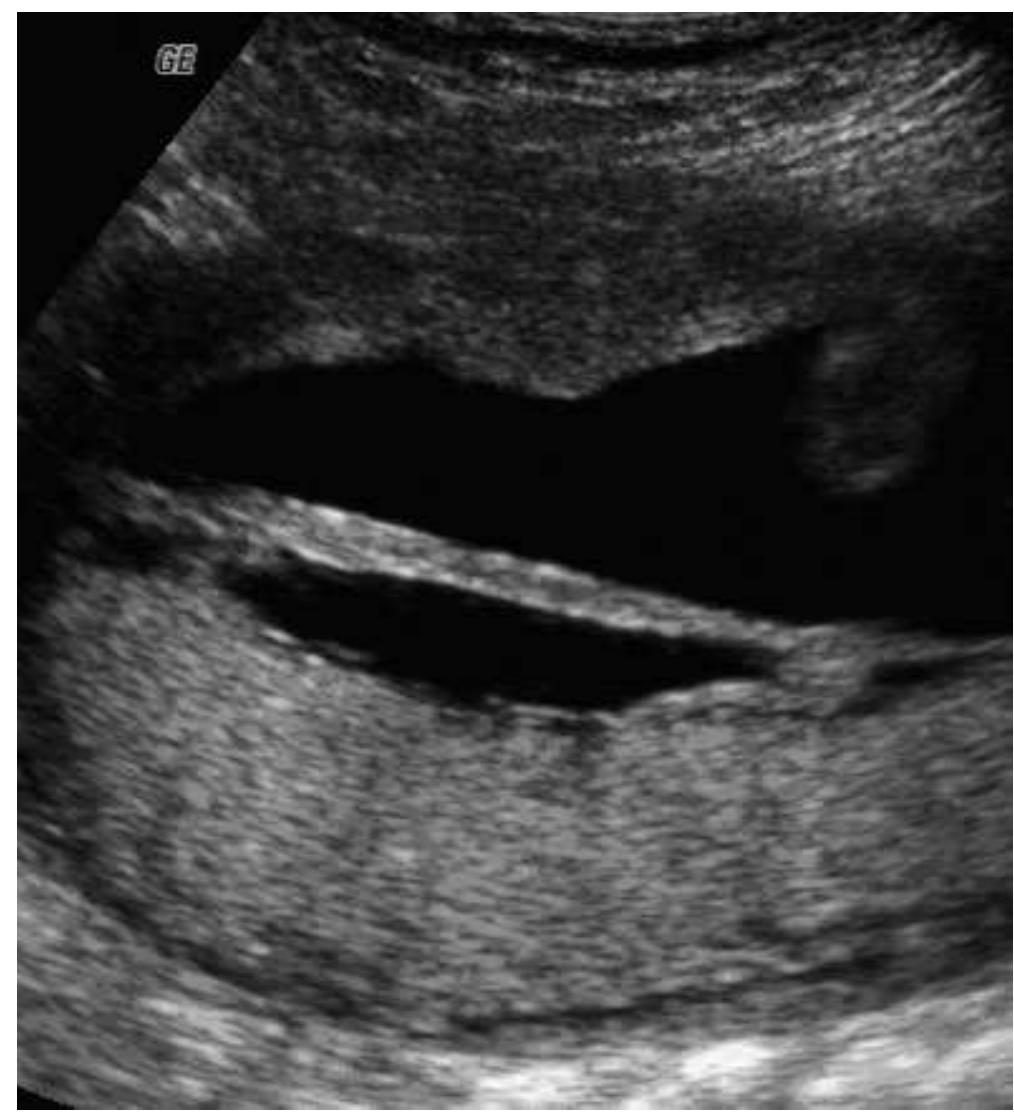 (PDF) Placental shelf - a common, typically transient and benign ...