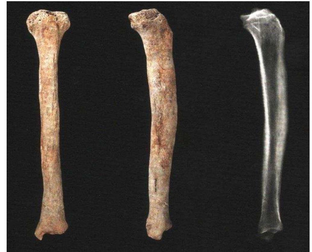 Thickening of the bone from third stage syphilis