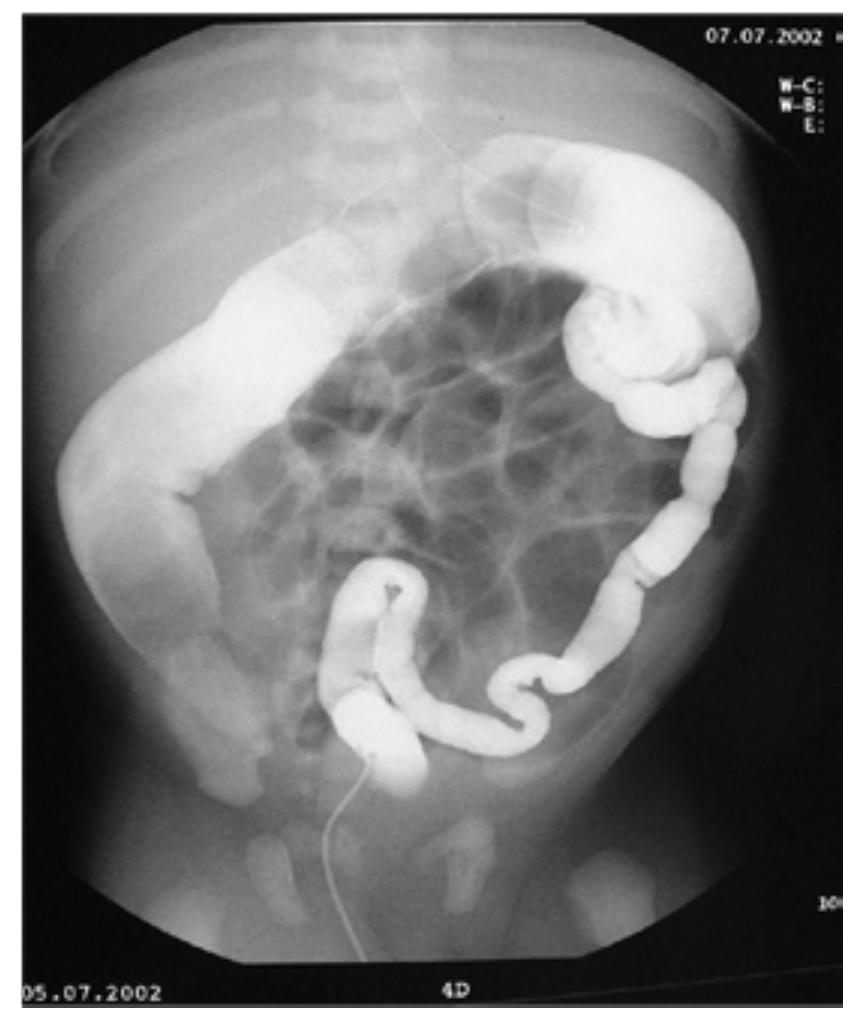 5: contrast enema in hirschsprung’s disease showing diseasea