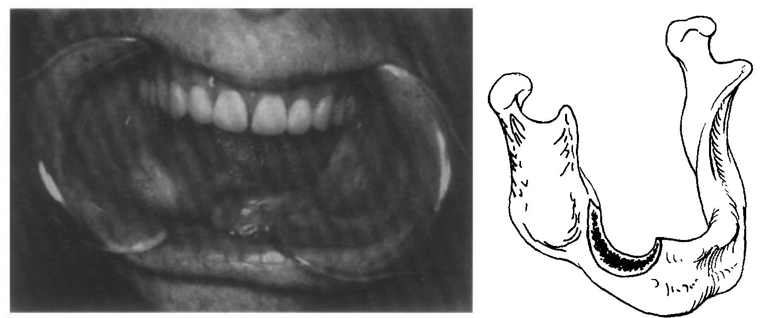 , class i. radical mandibular alveolectomy. procedures on a