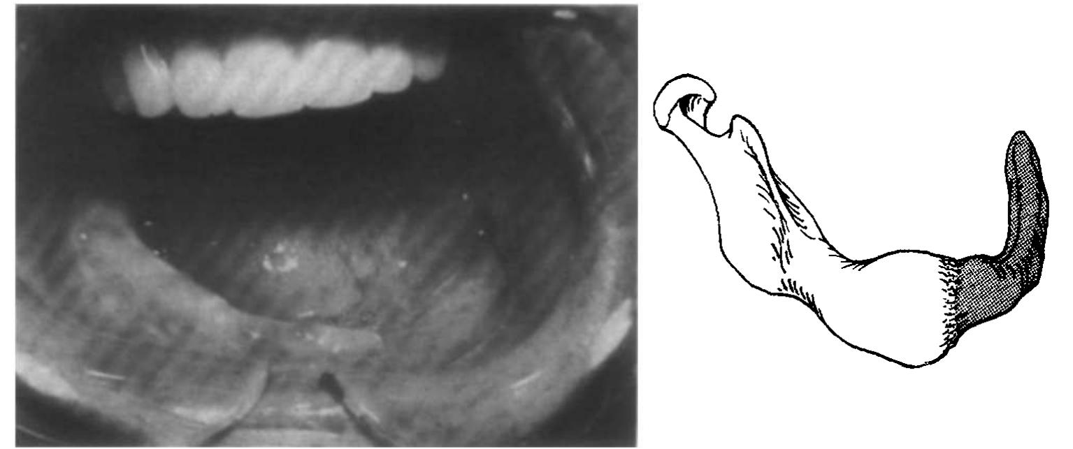 Class iv. lateral bone and split-thickness skin graft.