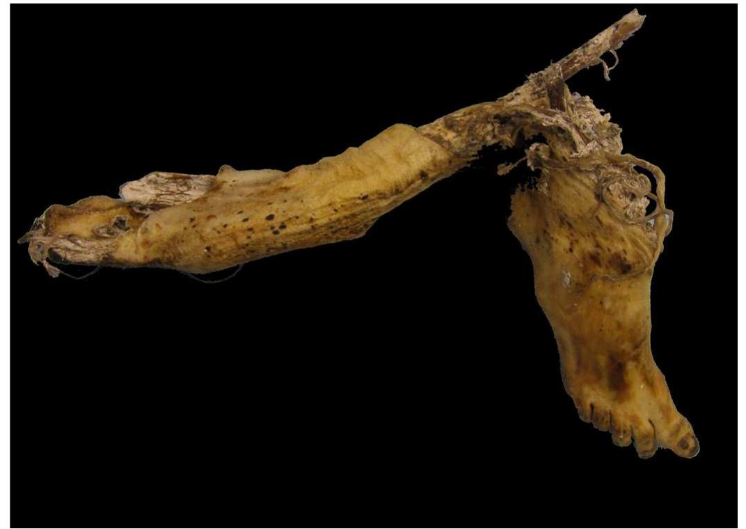 Preservation of right lower limb to include soft and