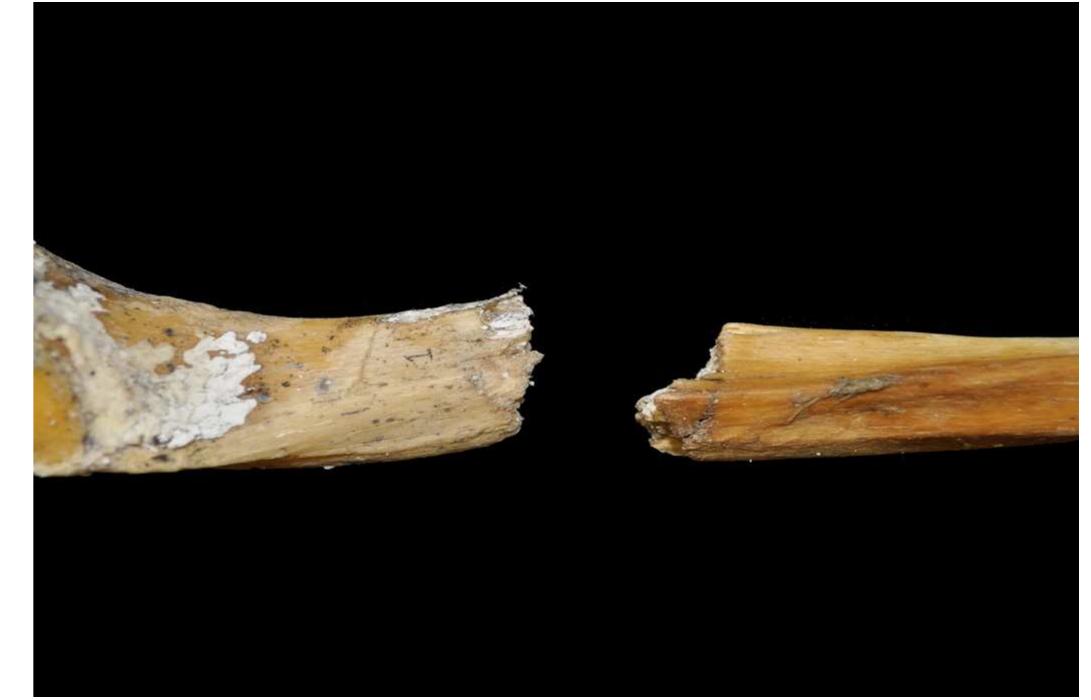 Perimortem trauma of ulnar shaft with evidence of postmortem