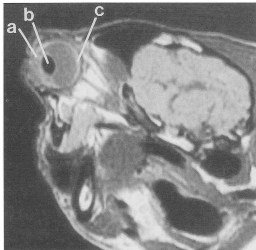 A t,-weighted oblique sagittal plane mri of the left orbit
