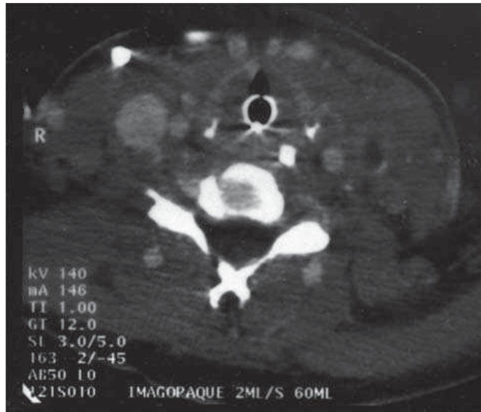 Thrombosis of the left internal jugular vein in a contrast-