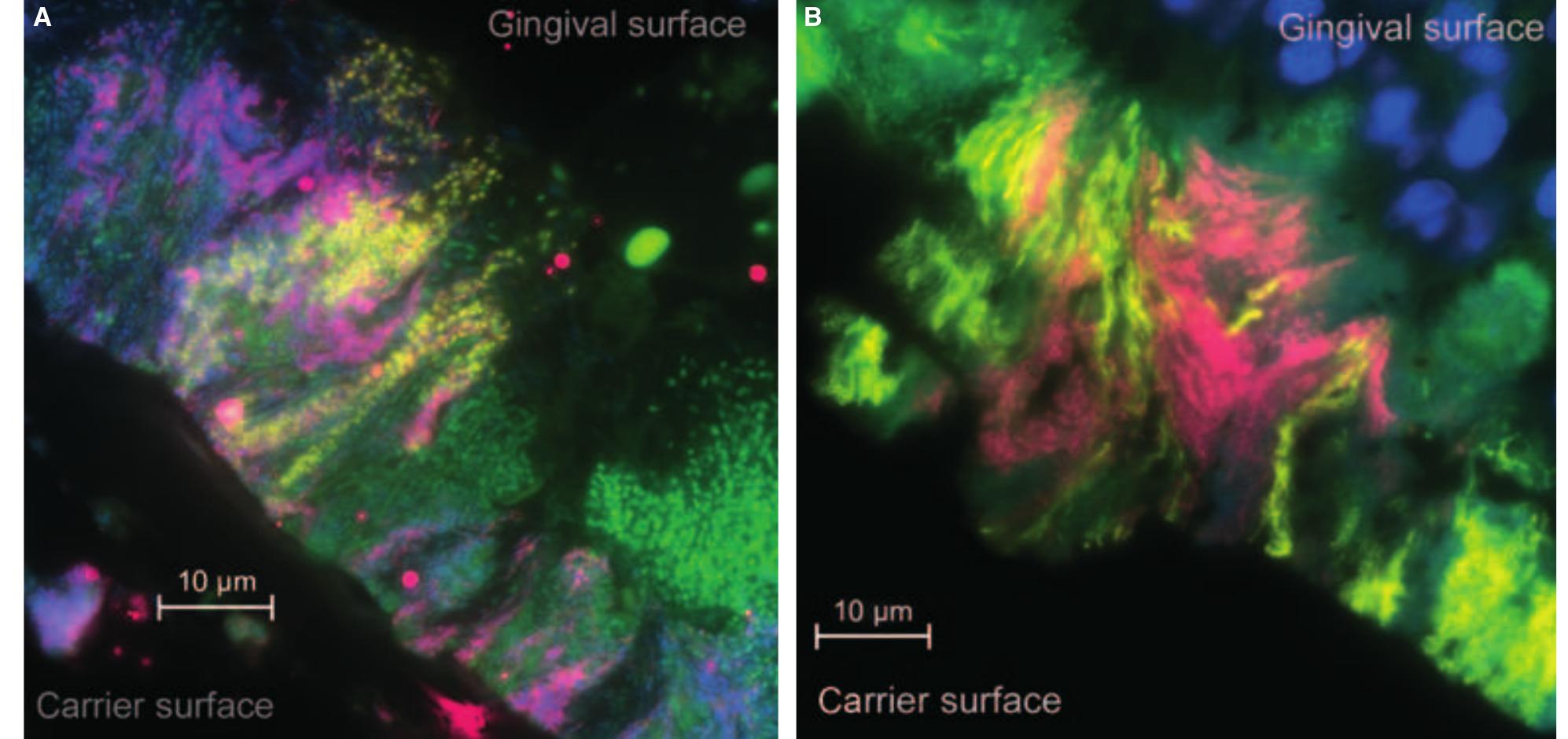 ‘mosaic’ architecture of 5-day-old subgingival bio- films