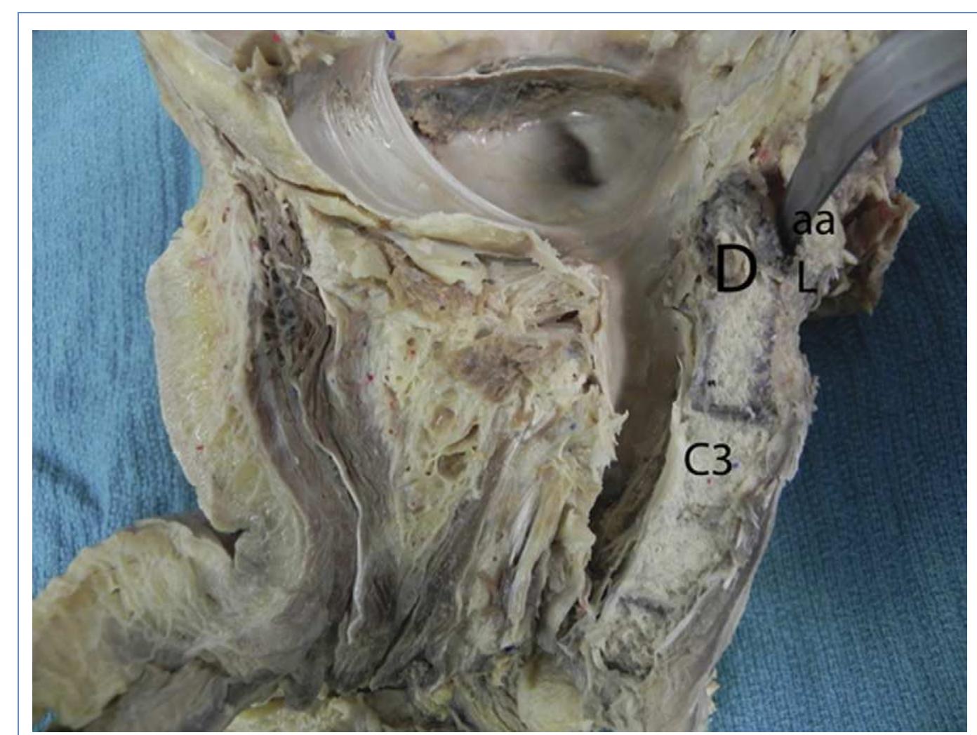 Cadaveric view (parasagittal) of the craniocervical junction