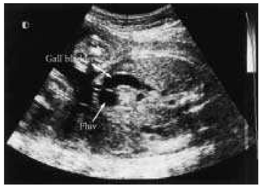 Figure 2 - from Varix of the fetal intra-abdominal umbilical
