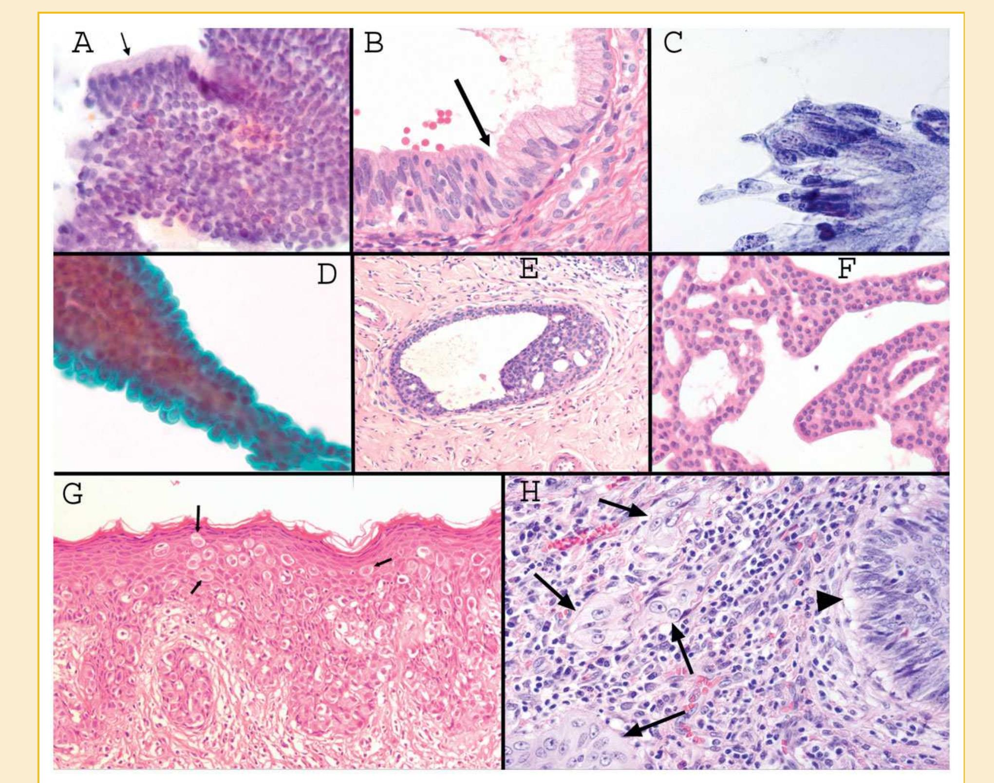 A: normal glandular epithelium breaks away from a basal