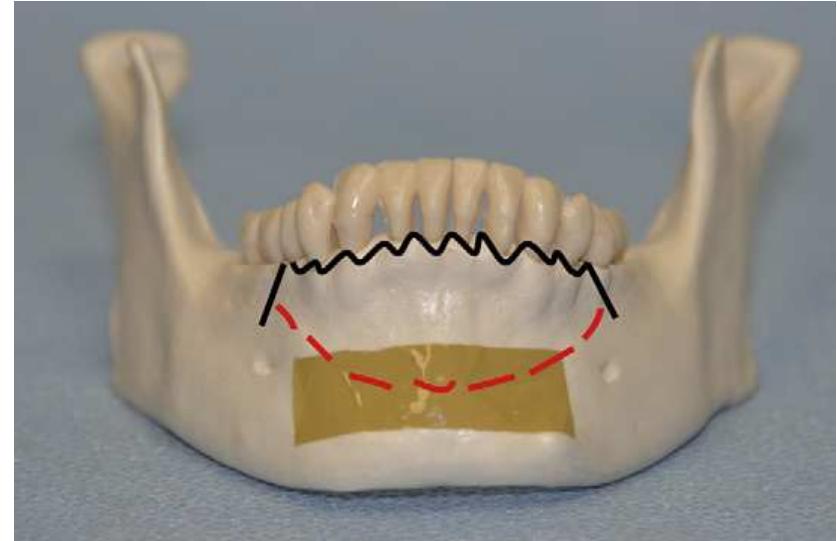 Harvesting of mandibular symphysis can be approached by