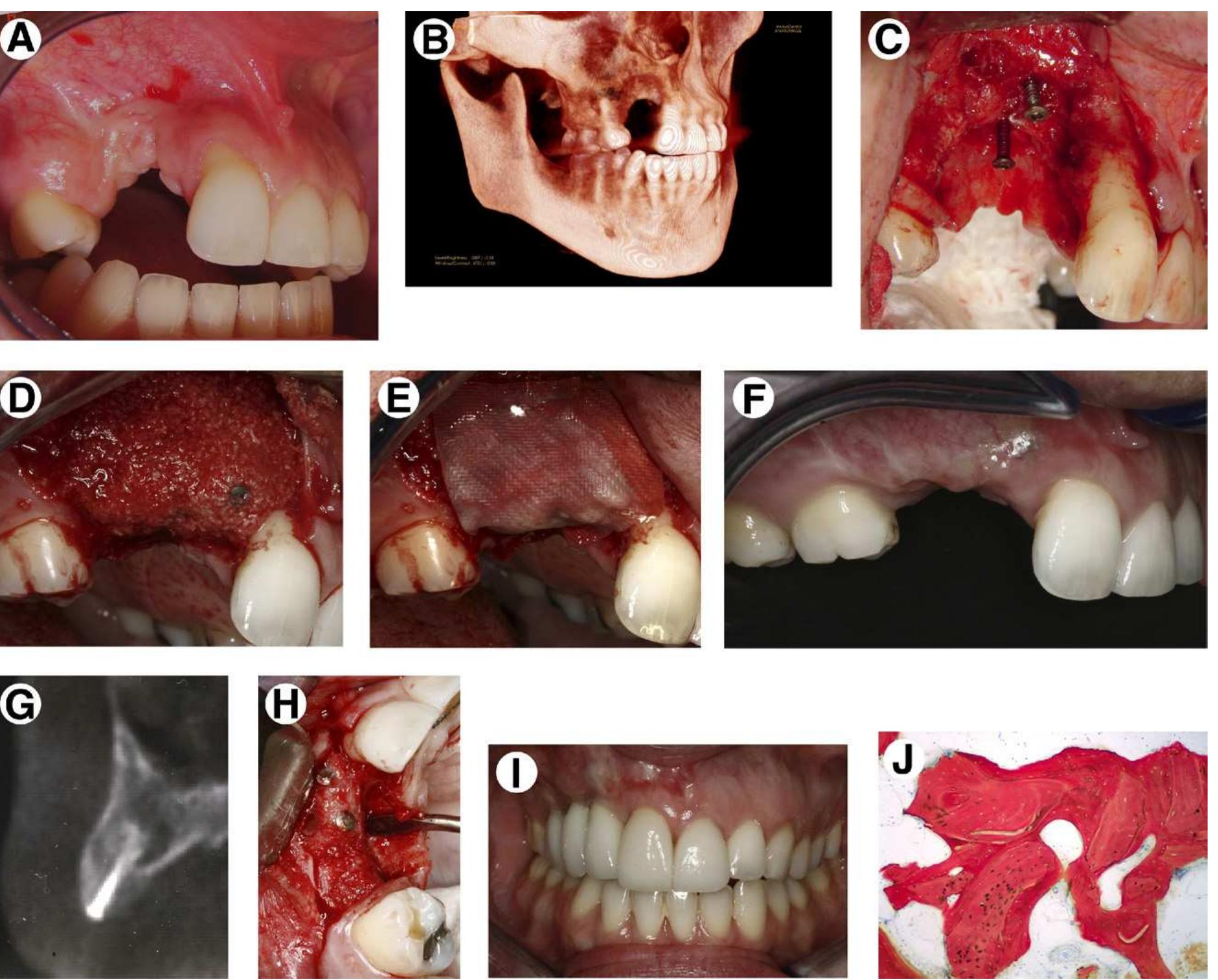 A, b, large vertical alveolar defect resulting from failed