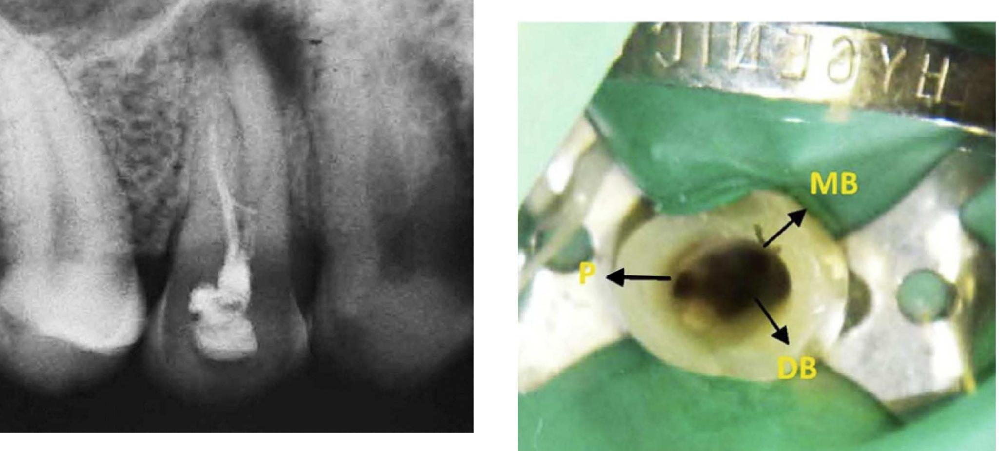 access opening showing three root canal orifices. coronal