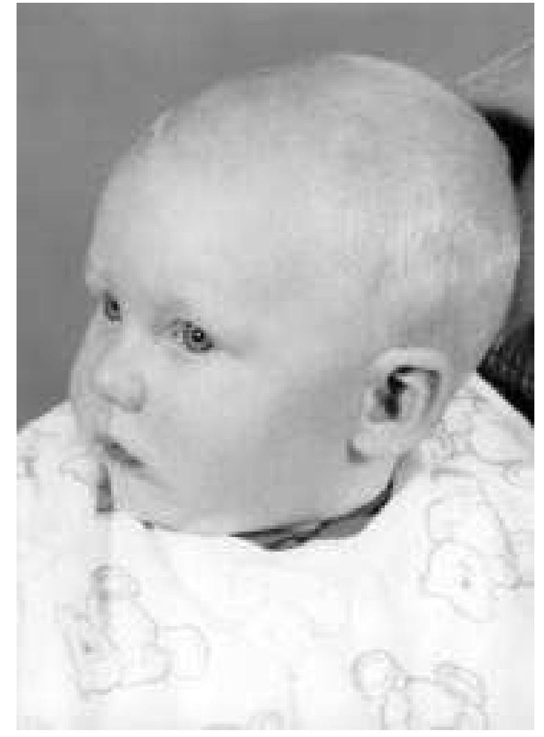 (PDF) Oculocutaneous albinism