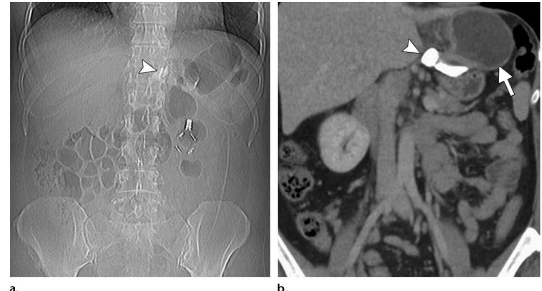 Anterior slippage of the gastric band in a 56-year-old woman