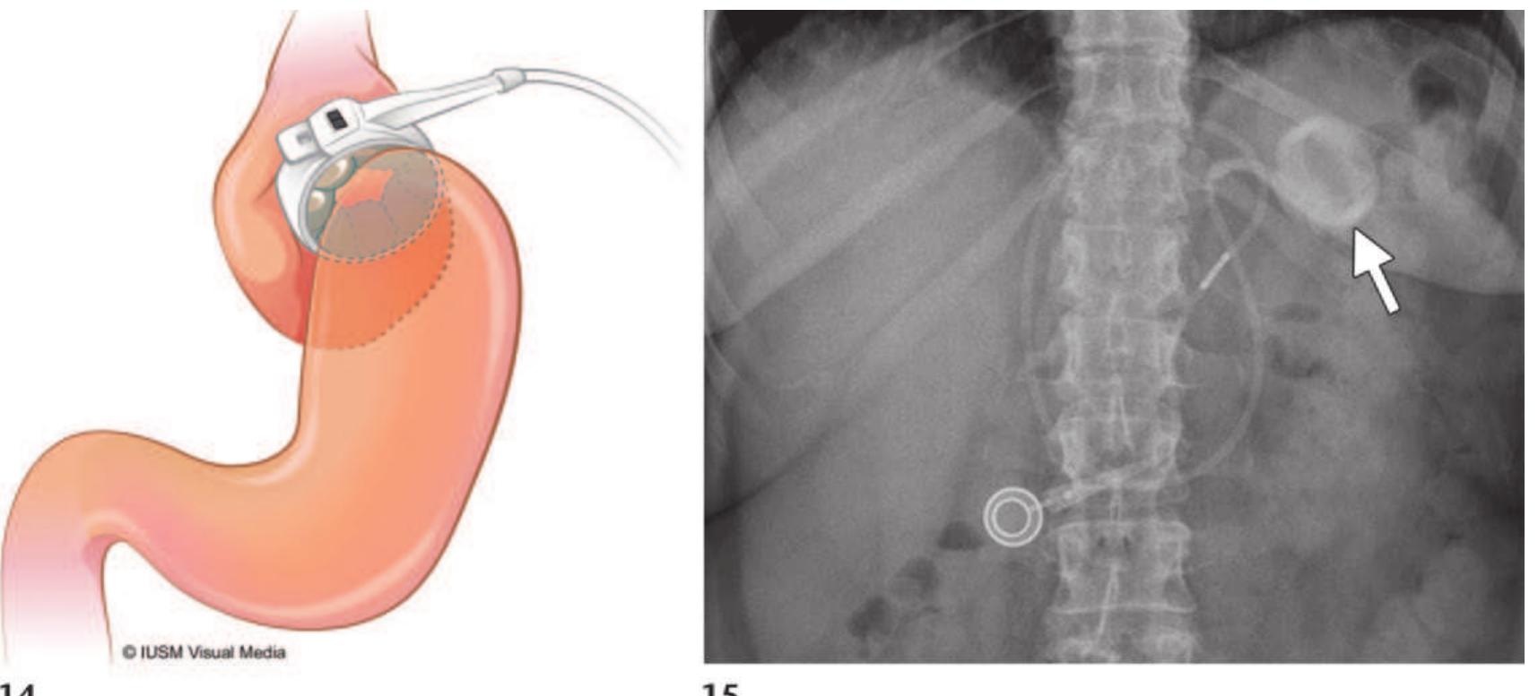 S 14, 15. (14) drawing depicts the gastric band position