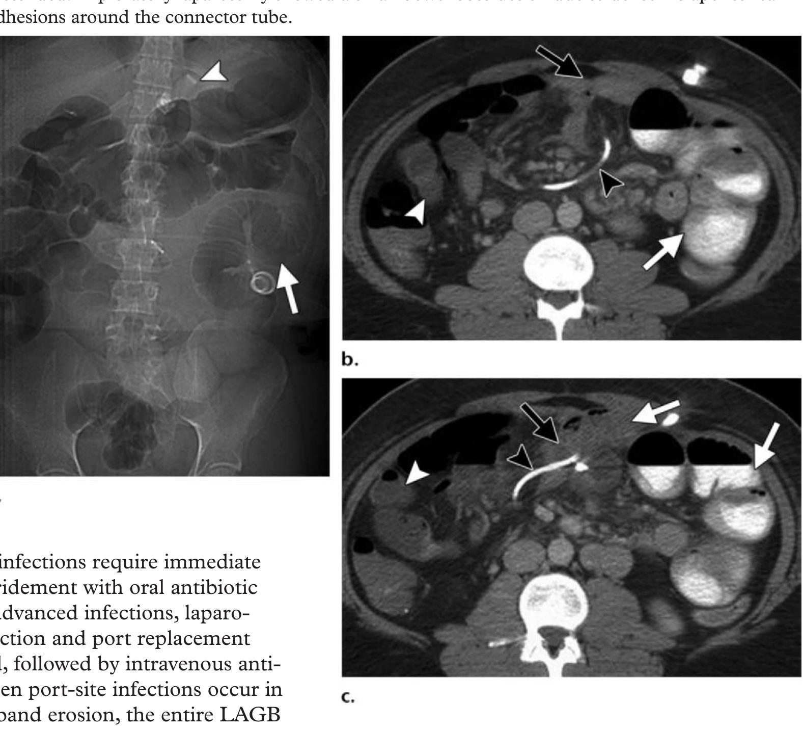 Figure 19 - Laparoscopic Adjustable Gastric Banding: What