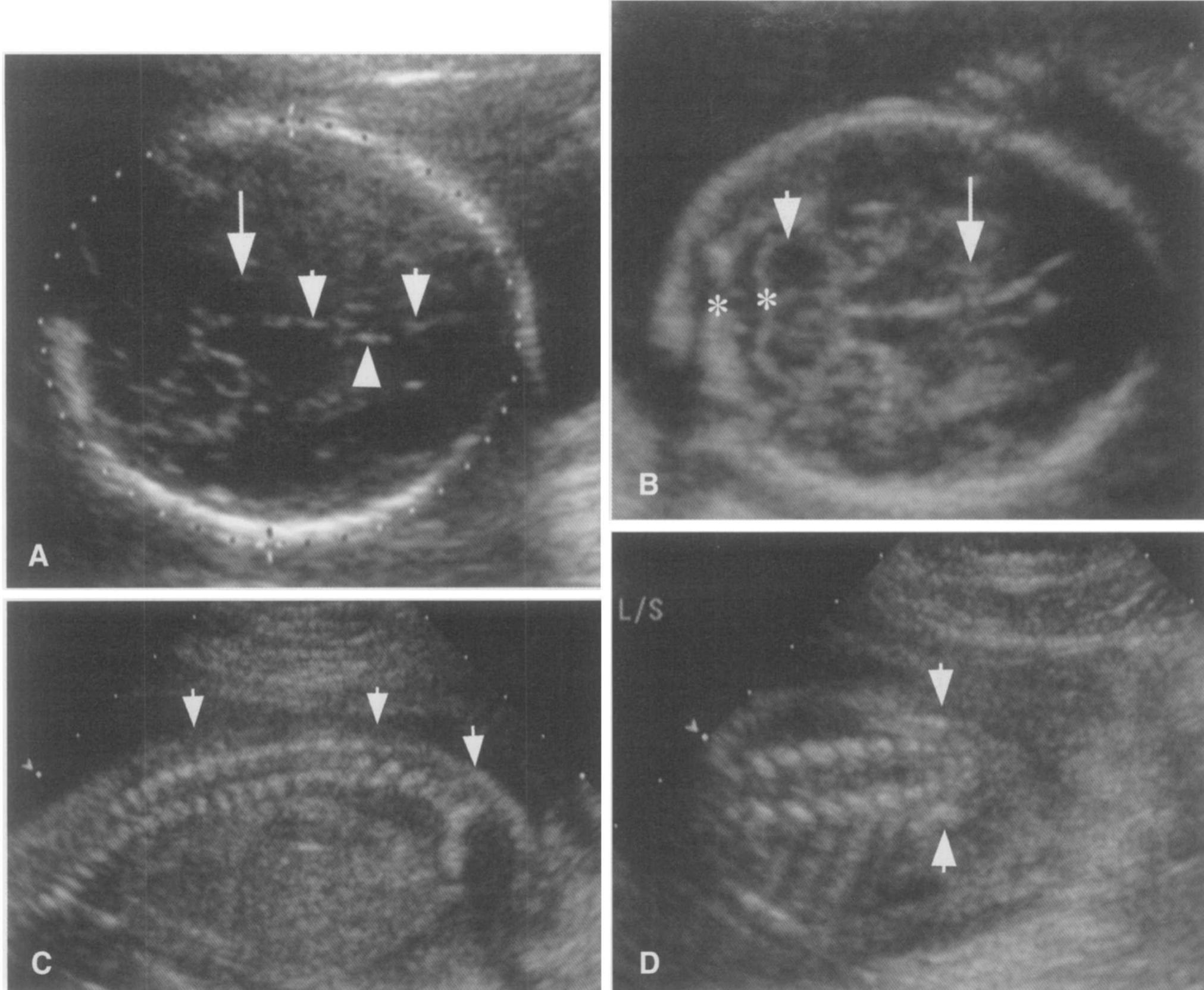 Normal anatomy. a, biparietal diameter. this image shows