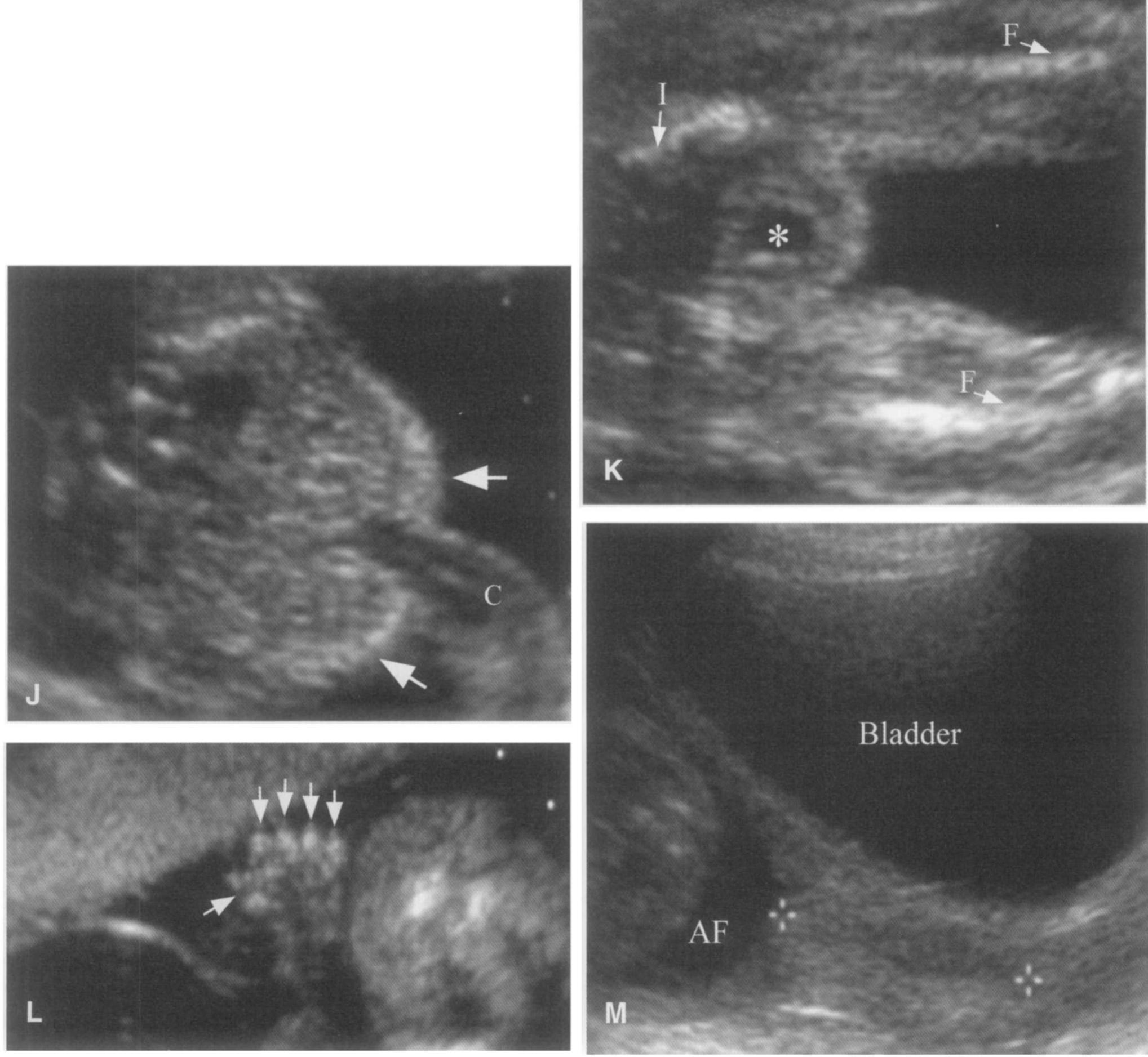 , (cont) j, cord insertion site. the umbilical cord is seen