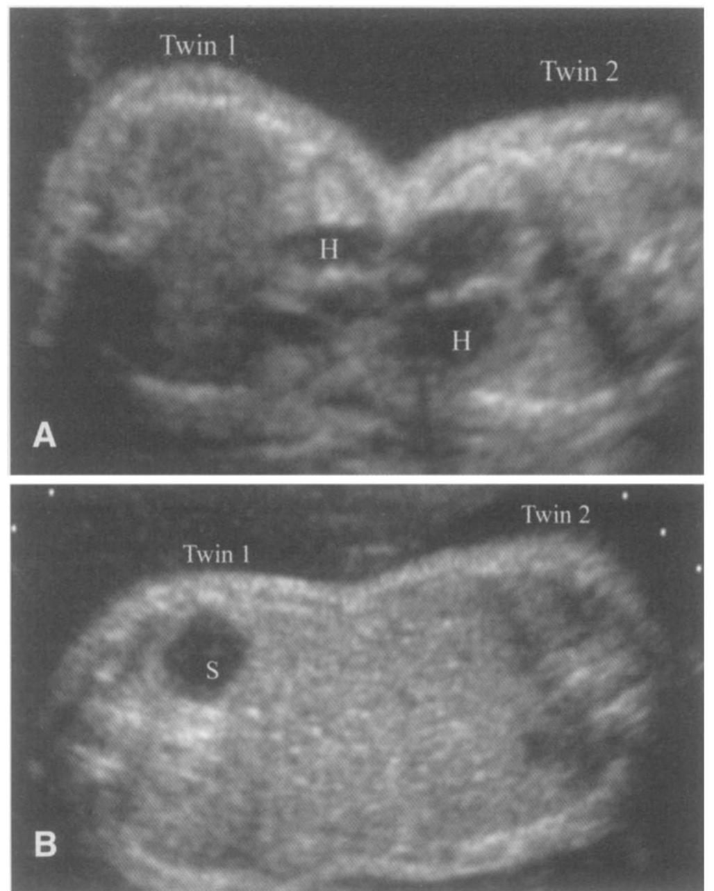 Thoracomphalopagus conjoined twins. a, cross section at the