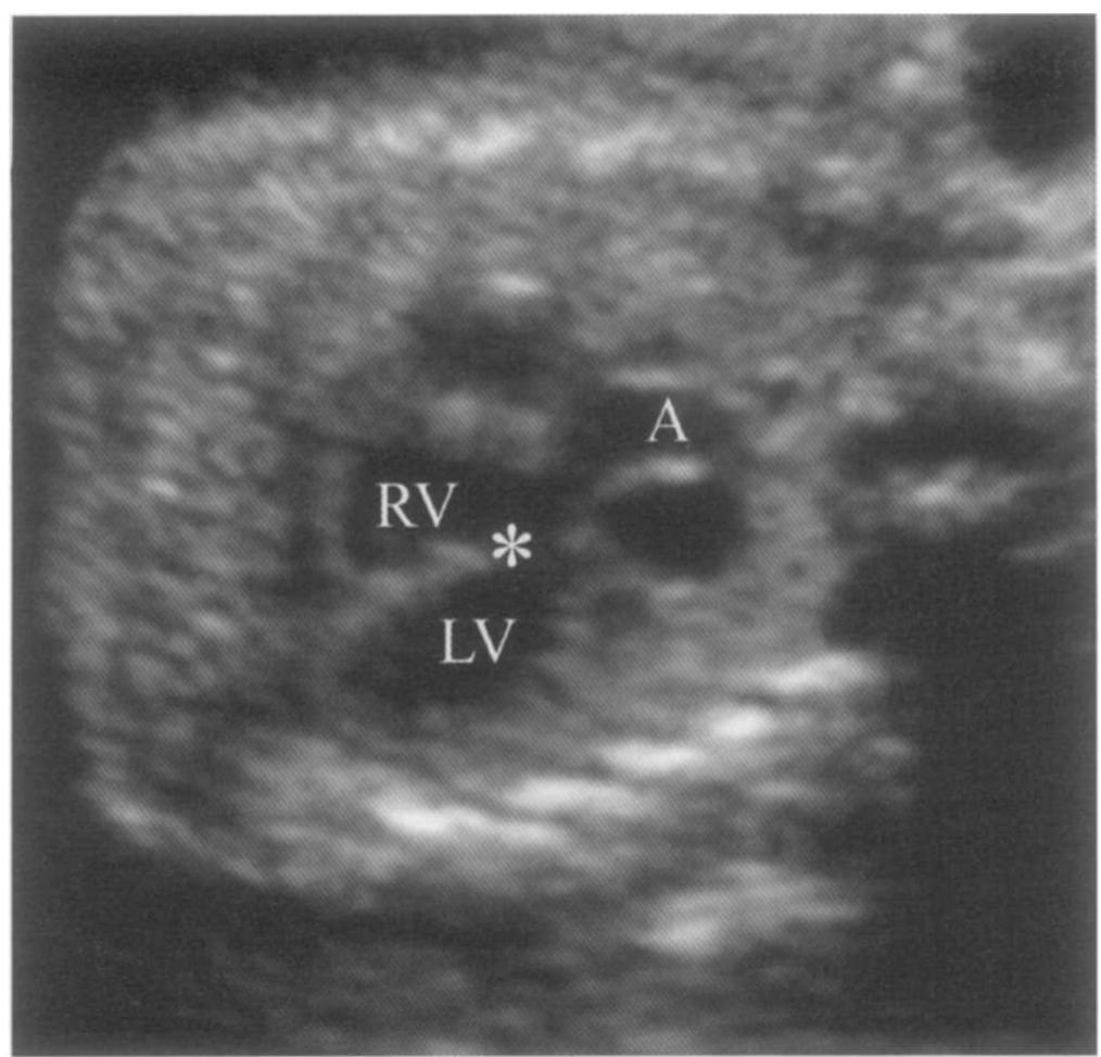 Tetralogy of fallot. the aorta {a) is overriding a