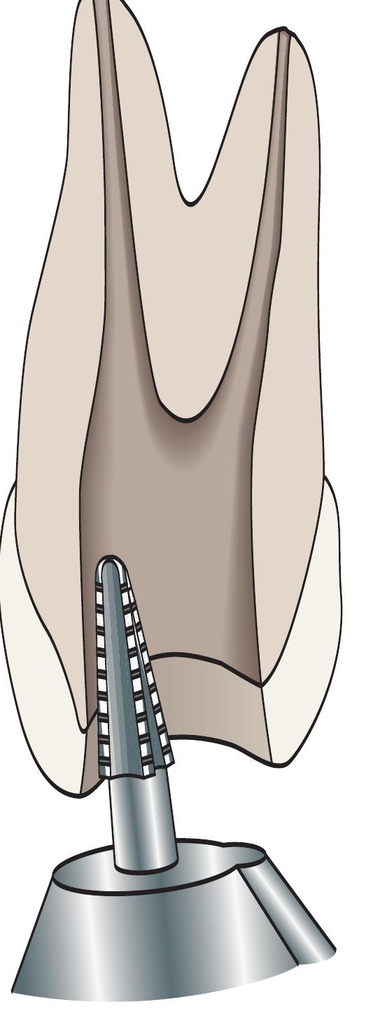 -29 maxillary premolar teeth. the cavity outline is then