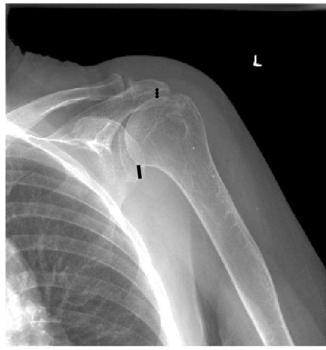 Superior migration of the humerus on the glenoid (solid
