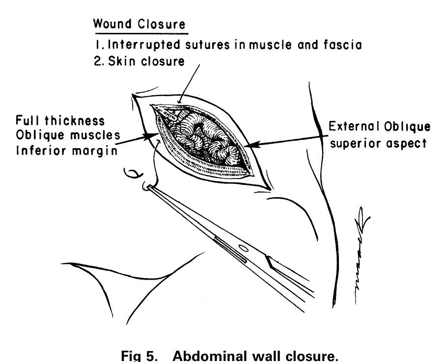 Figure 5 - The split abdominal wall muscle flap—a simple,