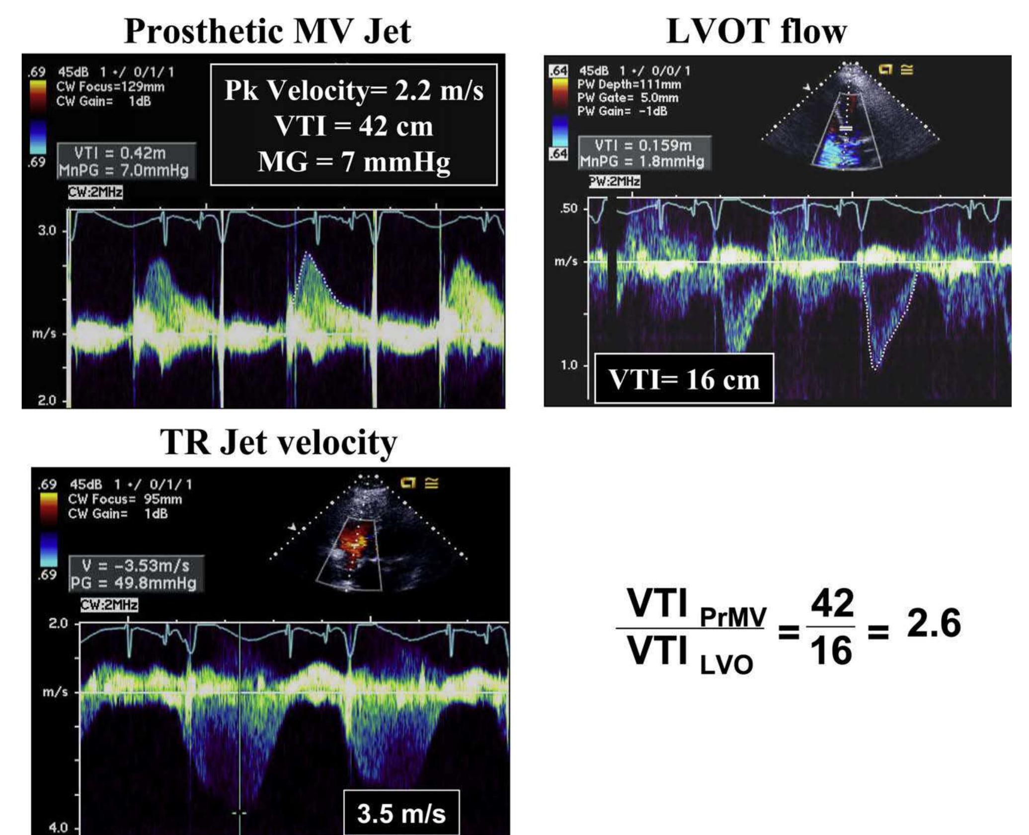 Transthoracic doppler echocardiographic clues for