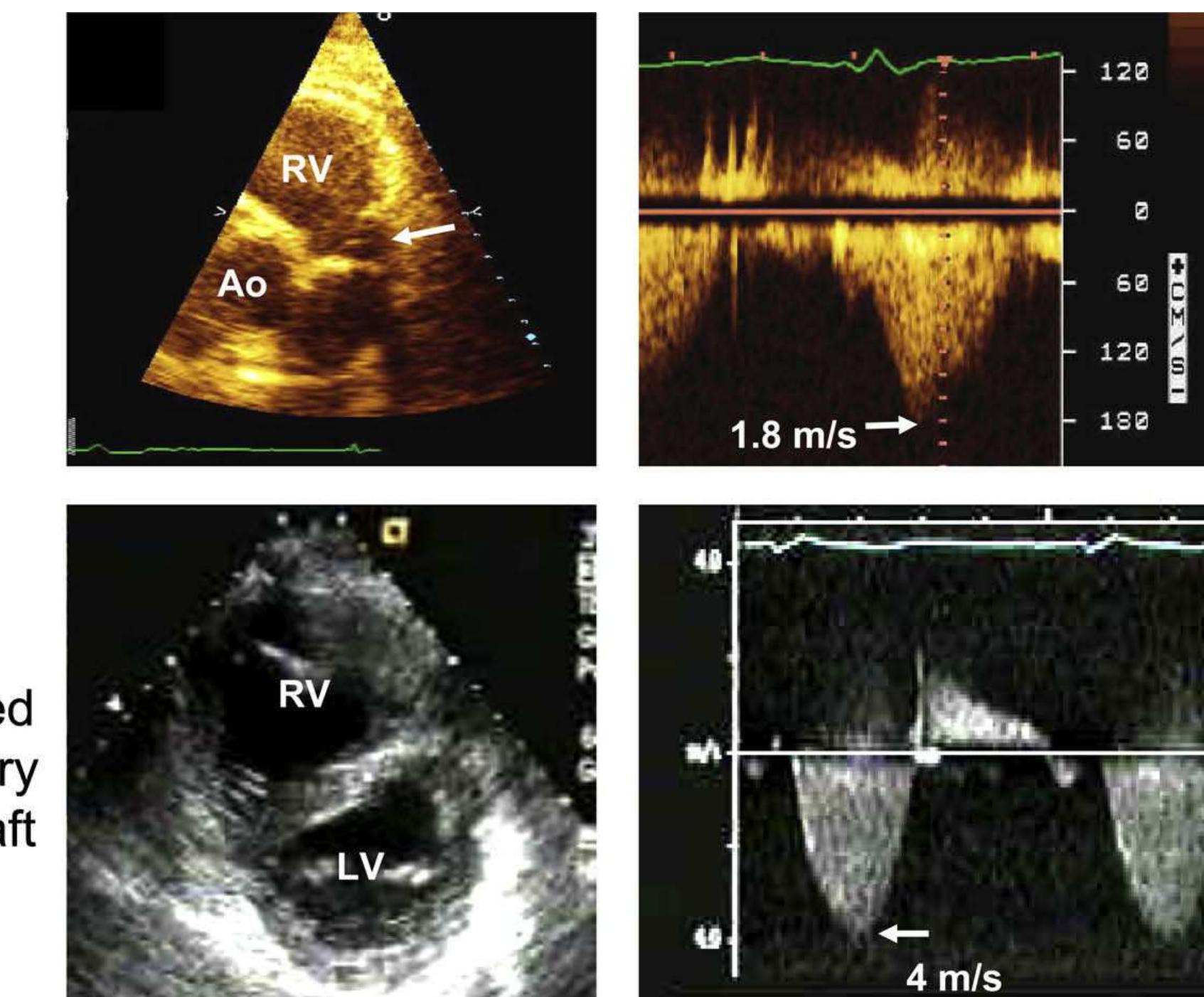 Examples of a normal prosthetic pulmonary valve and that of