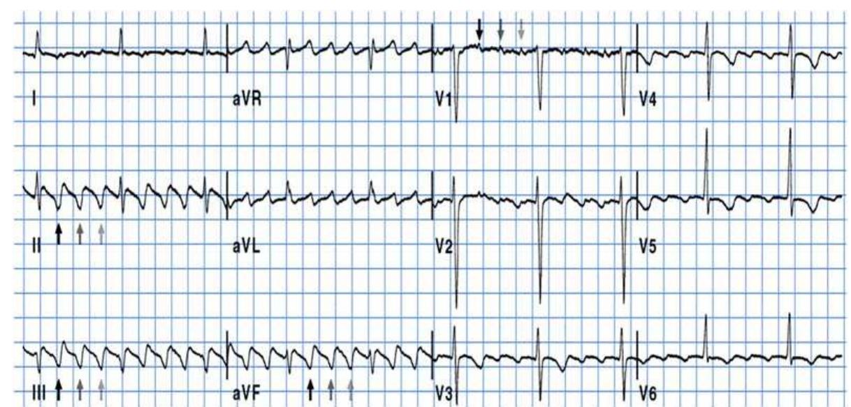 Typical, counterclockwise atrial flutter. the flutter waves
