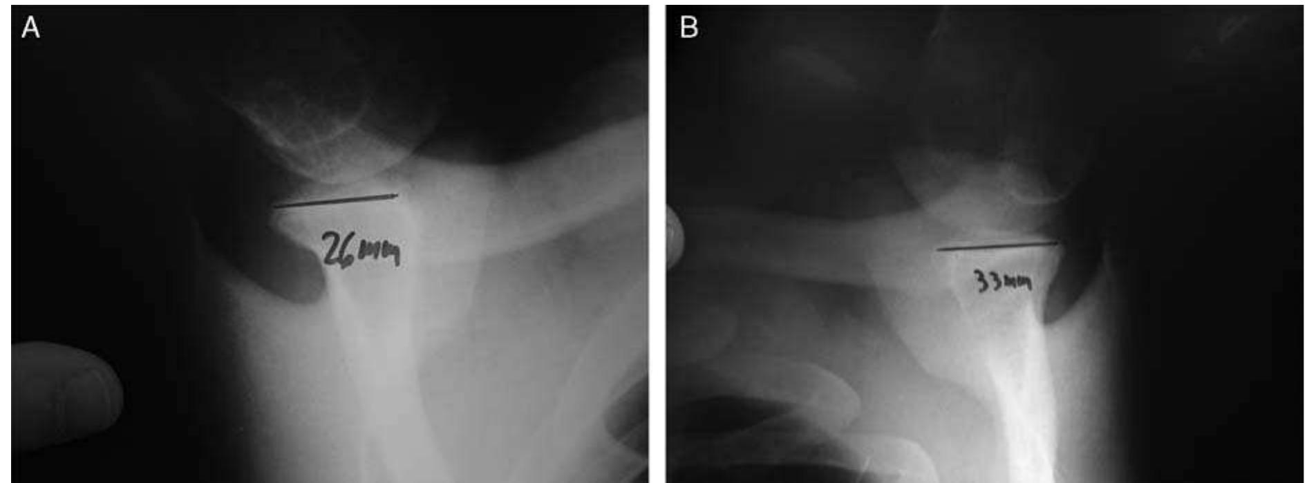 Example of calculation of the erosion, measuring the