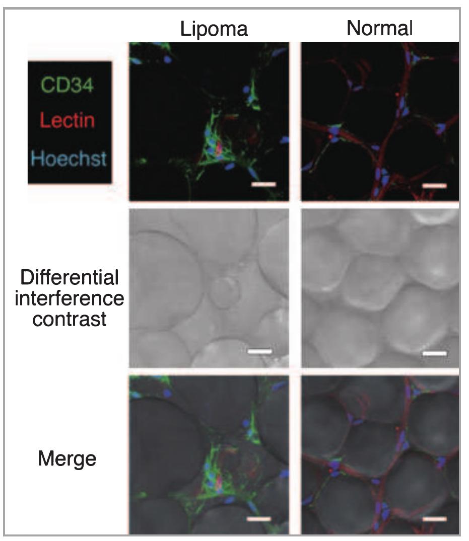 Whole-mount immunohistology of lipoma and normal adipos