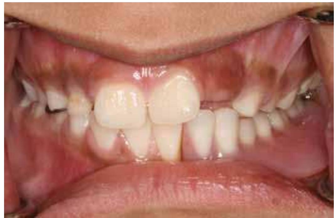 Ej frontal view of mandibular resection prosthesis in