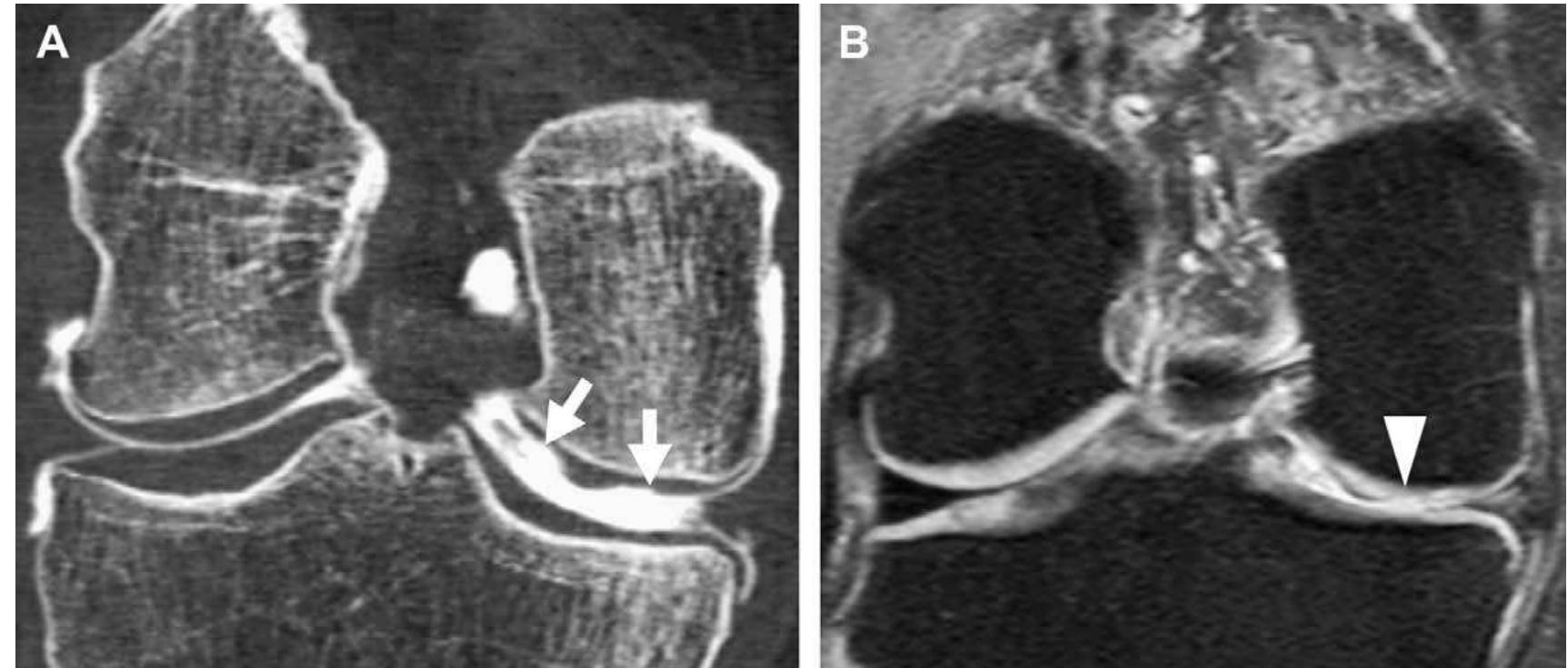46-year-old woman with osteoarthritis. (a) coronal ct