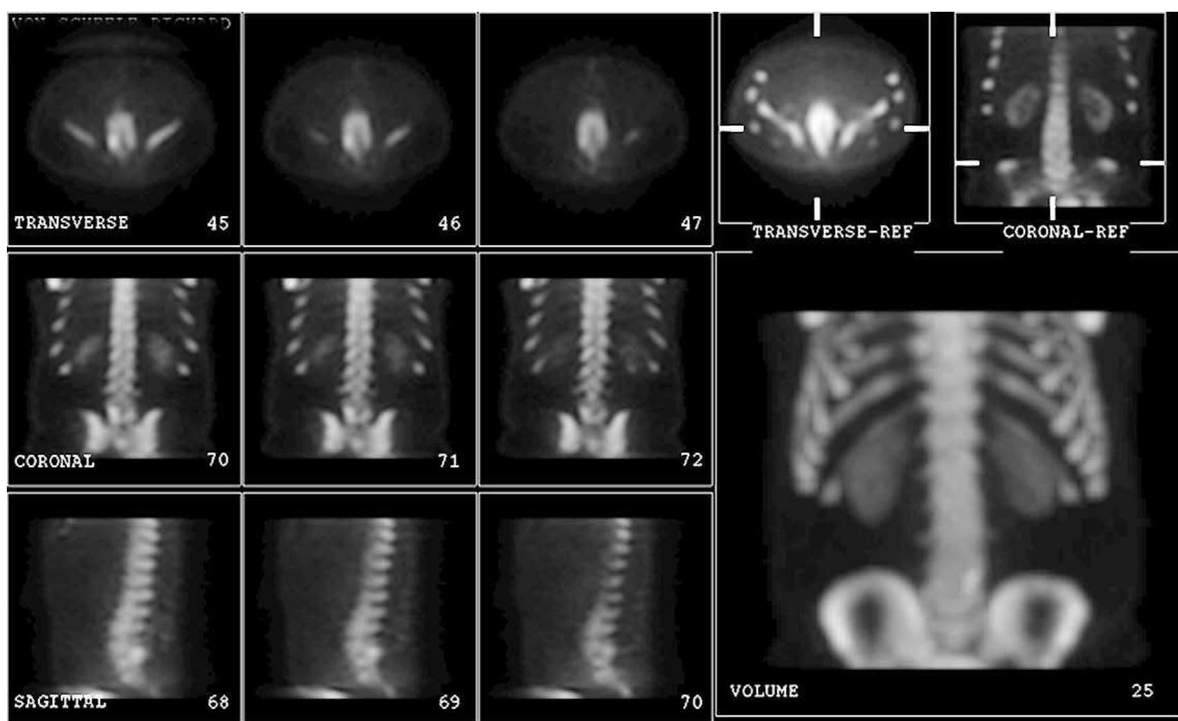 Selected views from a nonattenuation corrected 3-hour