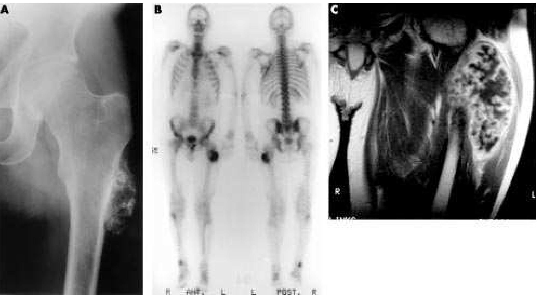 (a) an anterior-posterior radiograph of the left femur,