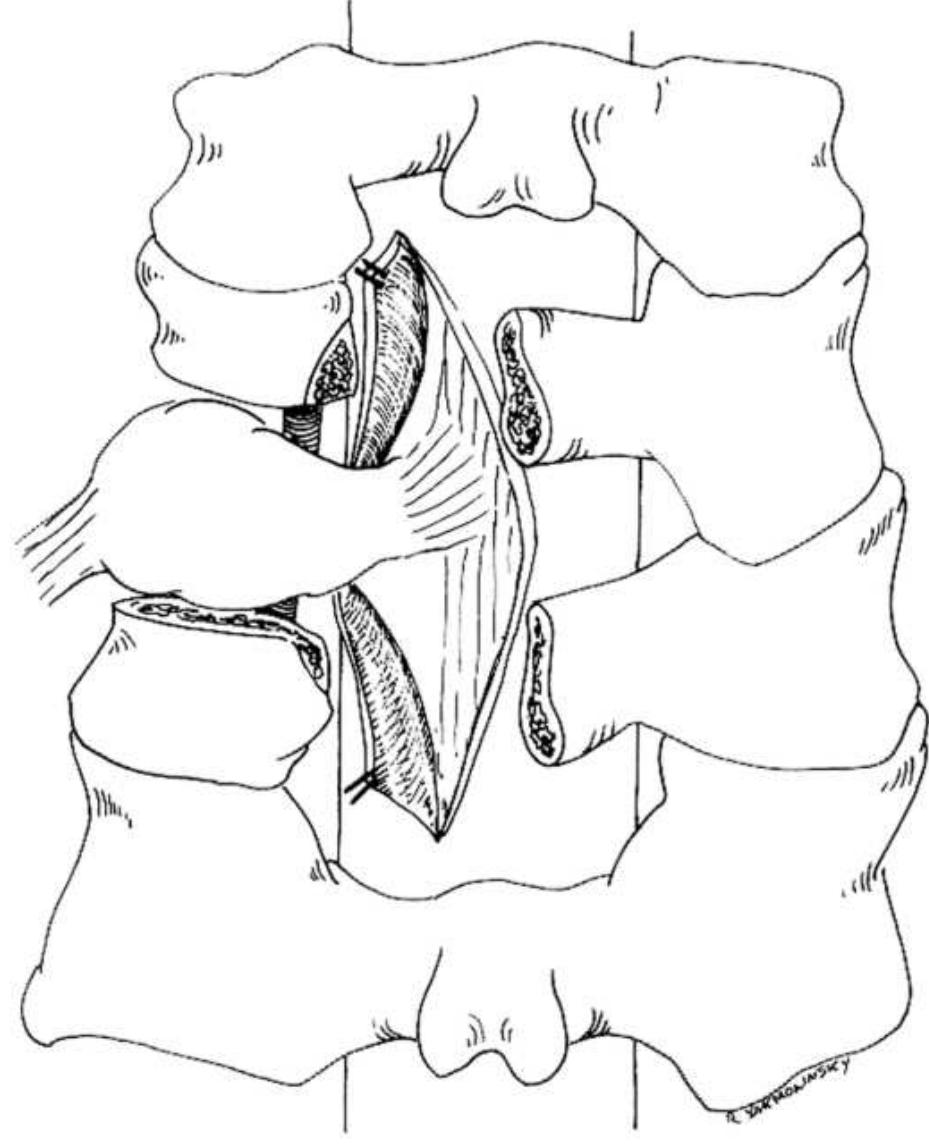 Diagram of the single-stage modified posterior midline
