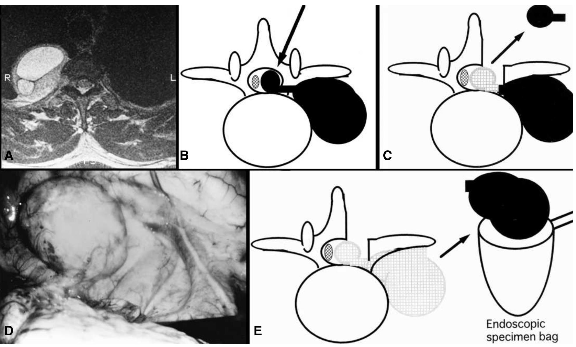 Figure 3 - from Surgical Approaches to Spinal Schwannomas
