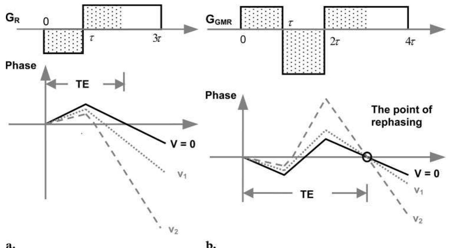 Schematics show the mr signal effects of flow compensation