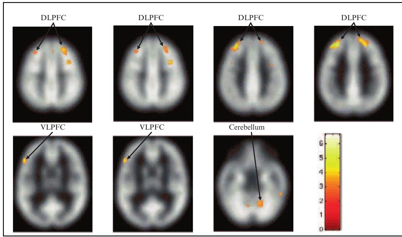 Voxel-based morphometry showing smaller gray matter volumes