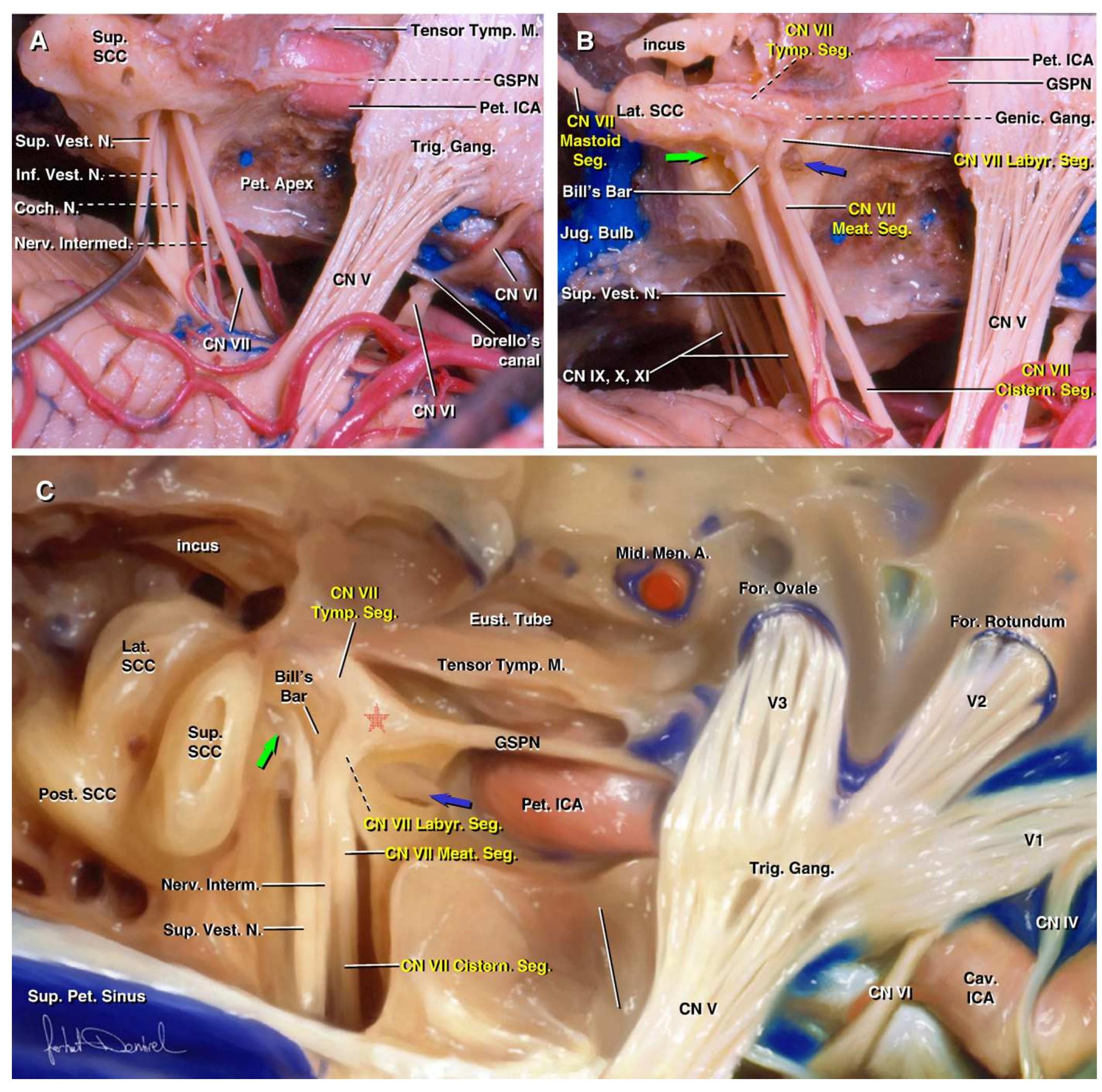 We performed the middle fossa approach in 5 cadavers (10