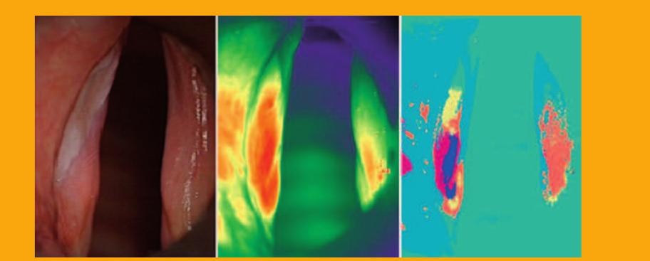 Different views of the human larynx in vivo: at hanis tion