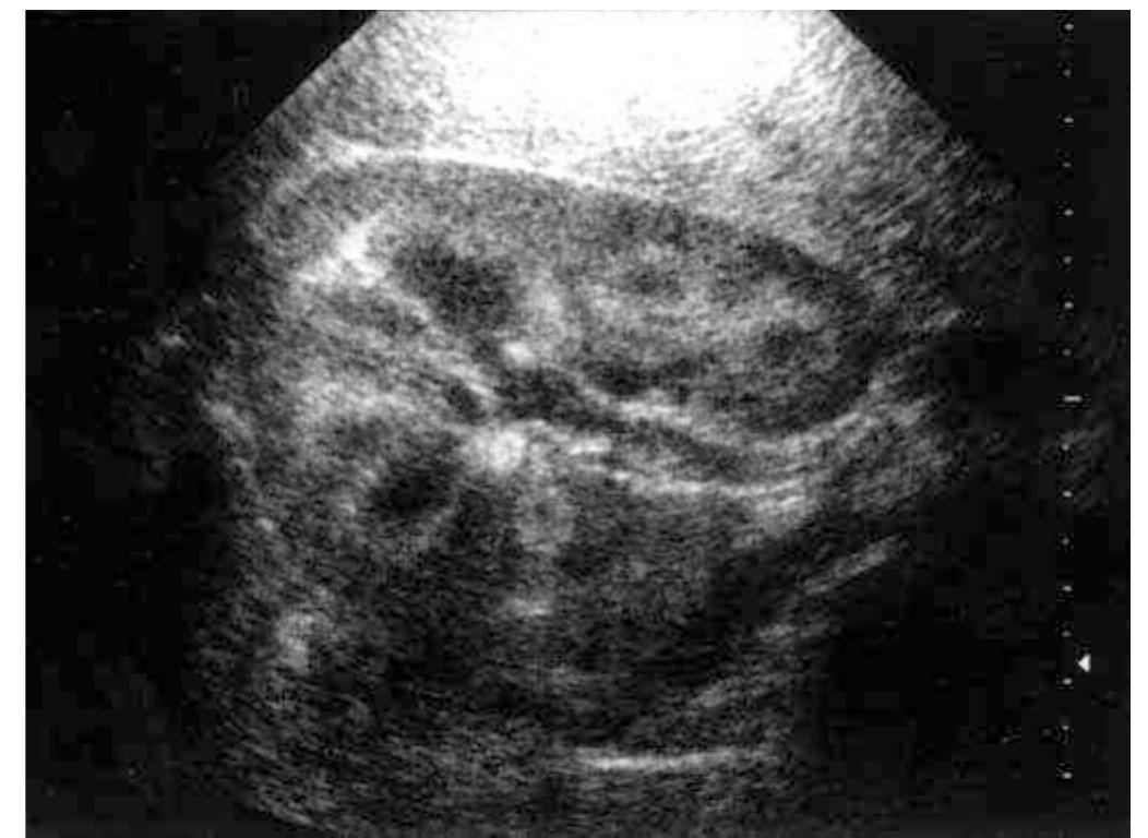 Transverse section through a kidney showing mild-to-