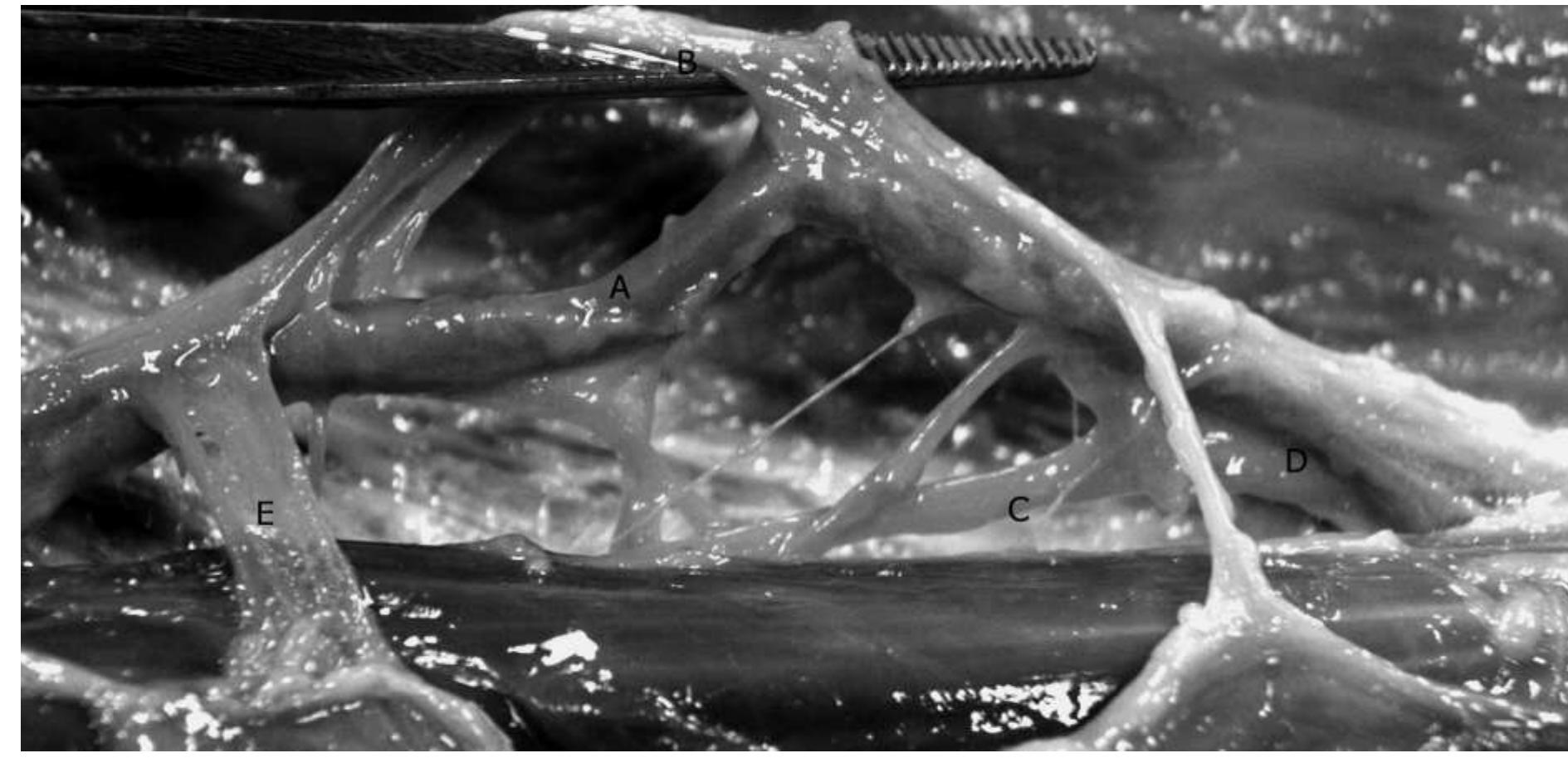 Neurovascular bundle with the fascial sheath dissected in